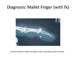 Mallet finger | PPTX