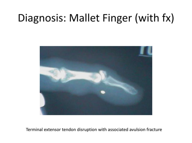 Mallet finger | PPT