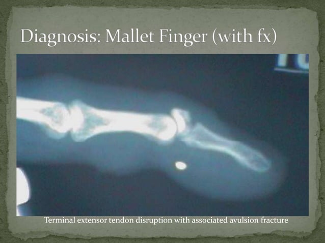 Mallet finger | PPT