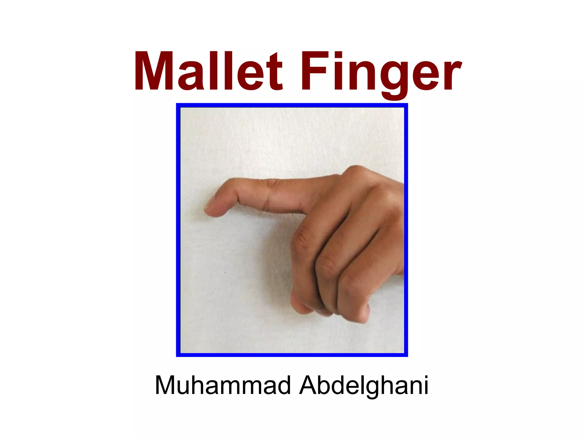 Mallet finger | PPT