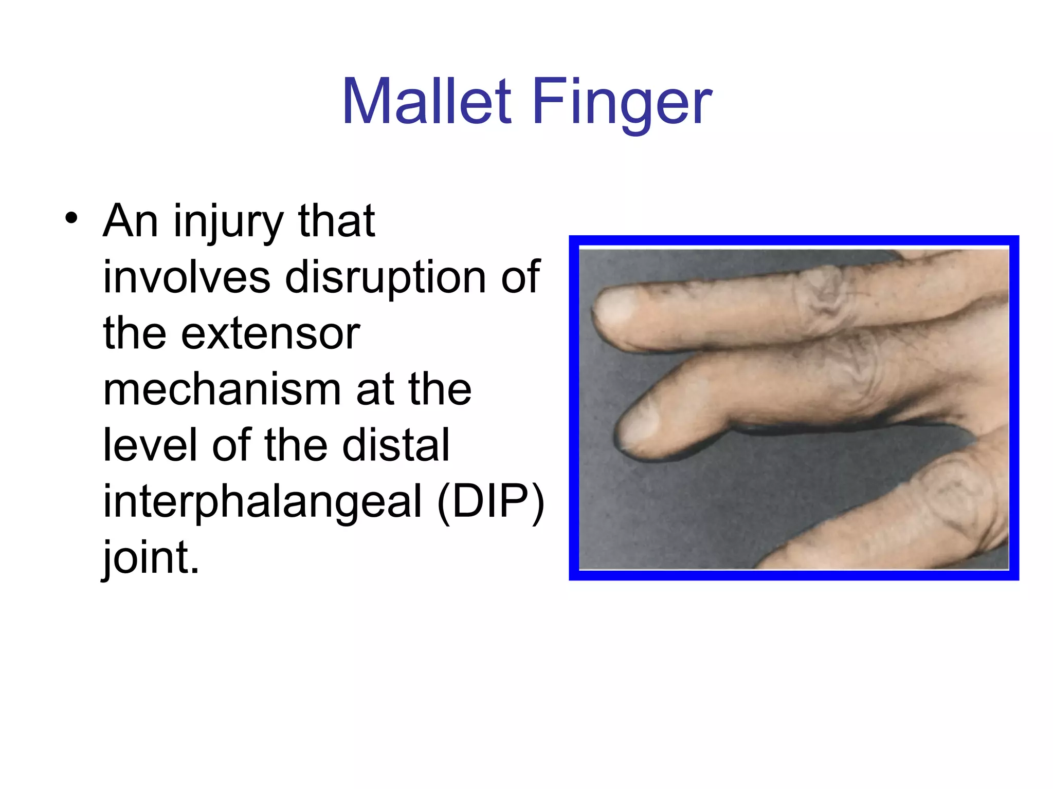Mallet finger | PPT