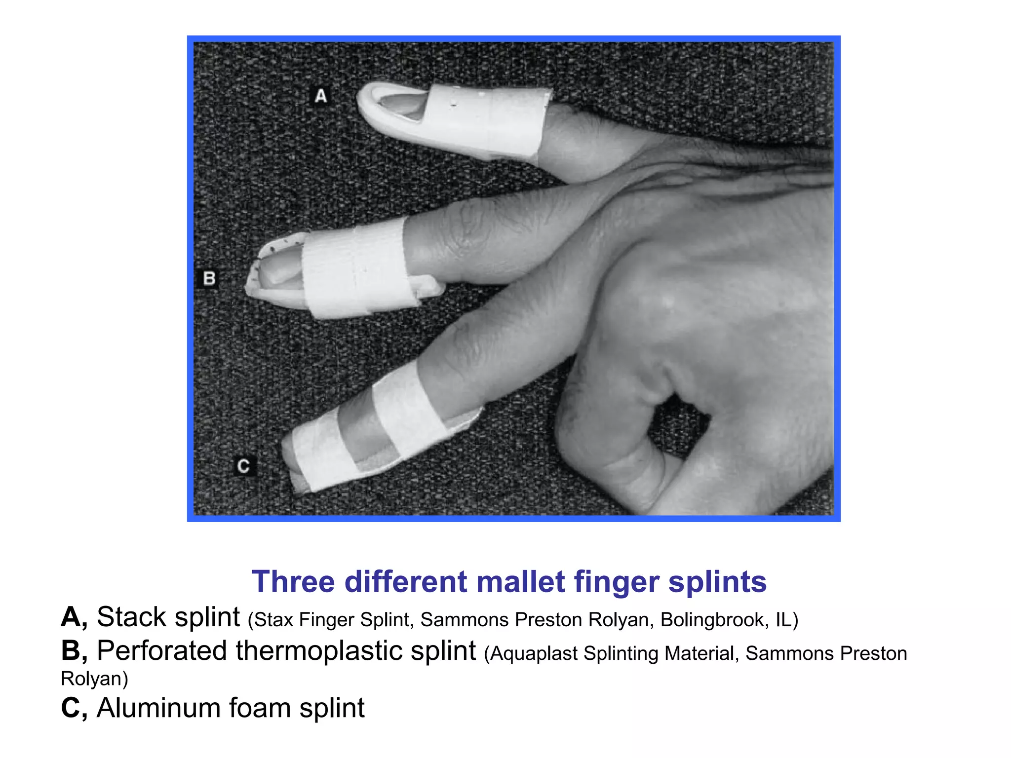 Mallet finger | PPT