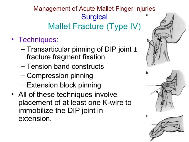 Mallet finger