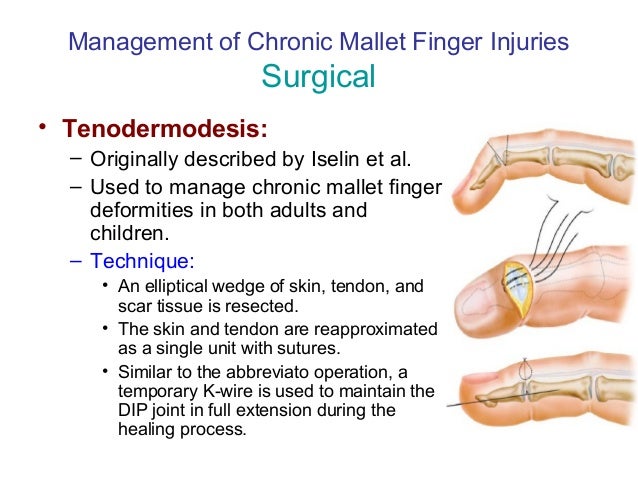 Mallet finger