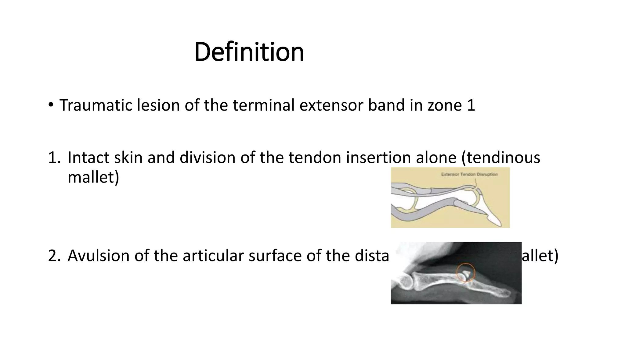 Mallet finger | PPTX
