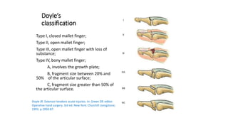 Mallet finger | PPTX
