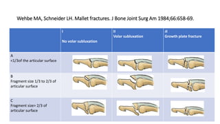 Mallet finger | PPTX