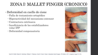 mallet finger dedos trifalangicos mano.pptx
