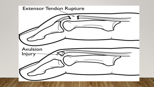 MALLET FINGER TREATMENT & PHYSIOTHERAPY MANAGEMENT | PPT