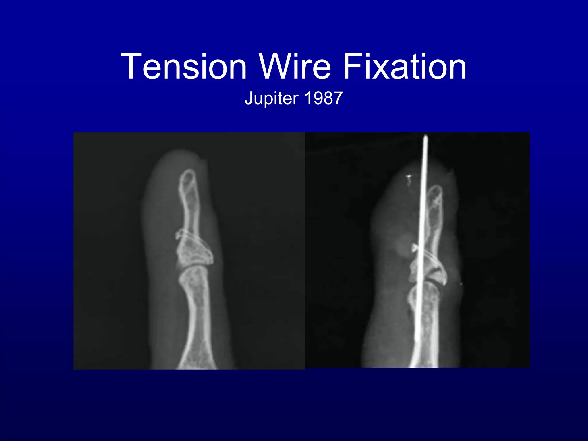 Percutaneous pin fixation of the mallet fracture, review of the ...