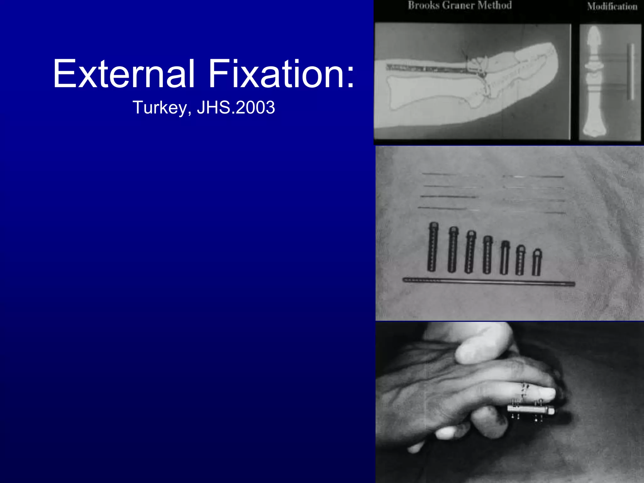 Percutaneous pin fixation of the mallet fracture, review of the ...