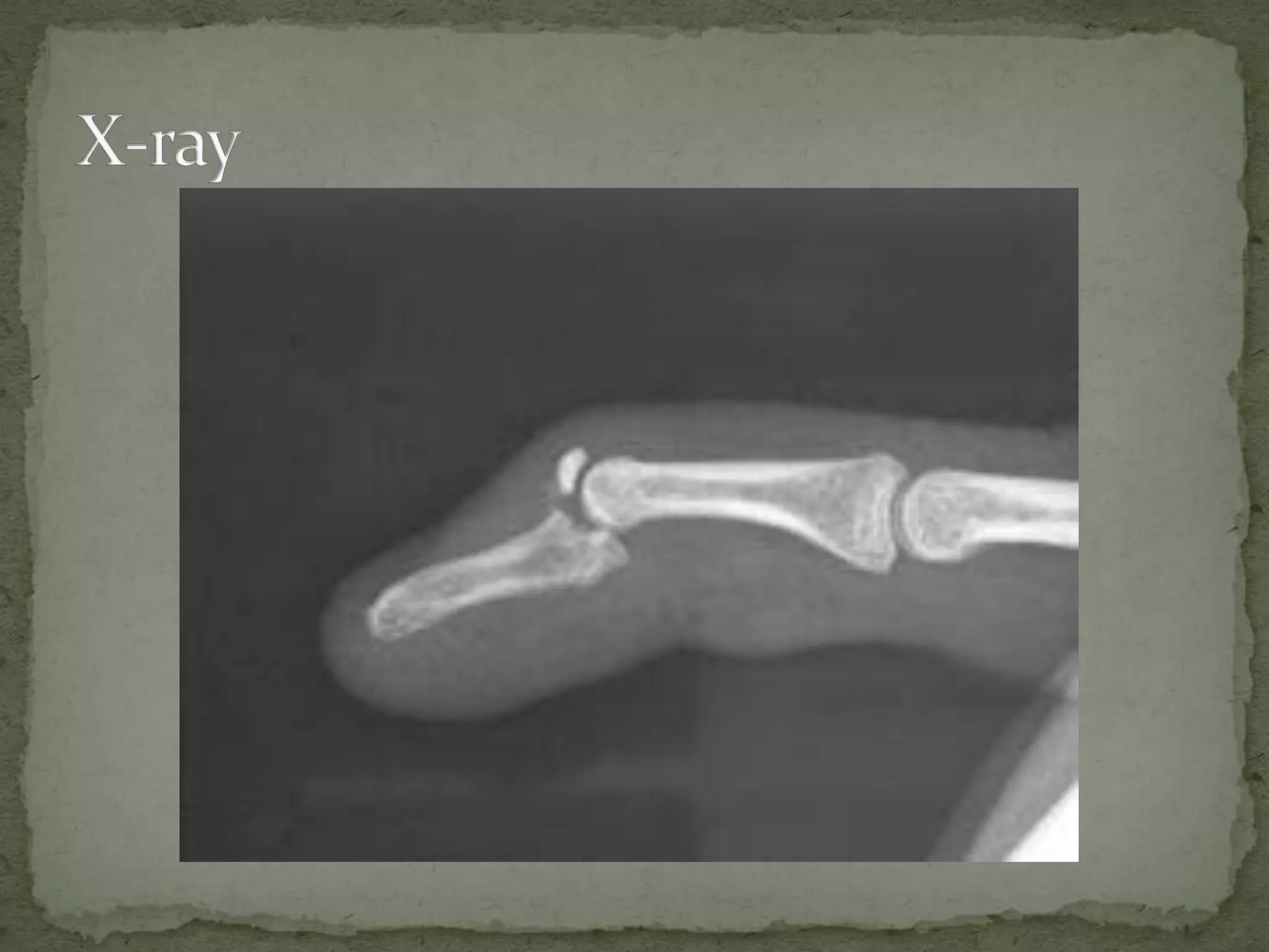 Mallet Finger Power Point | PPTX