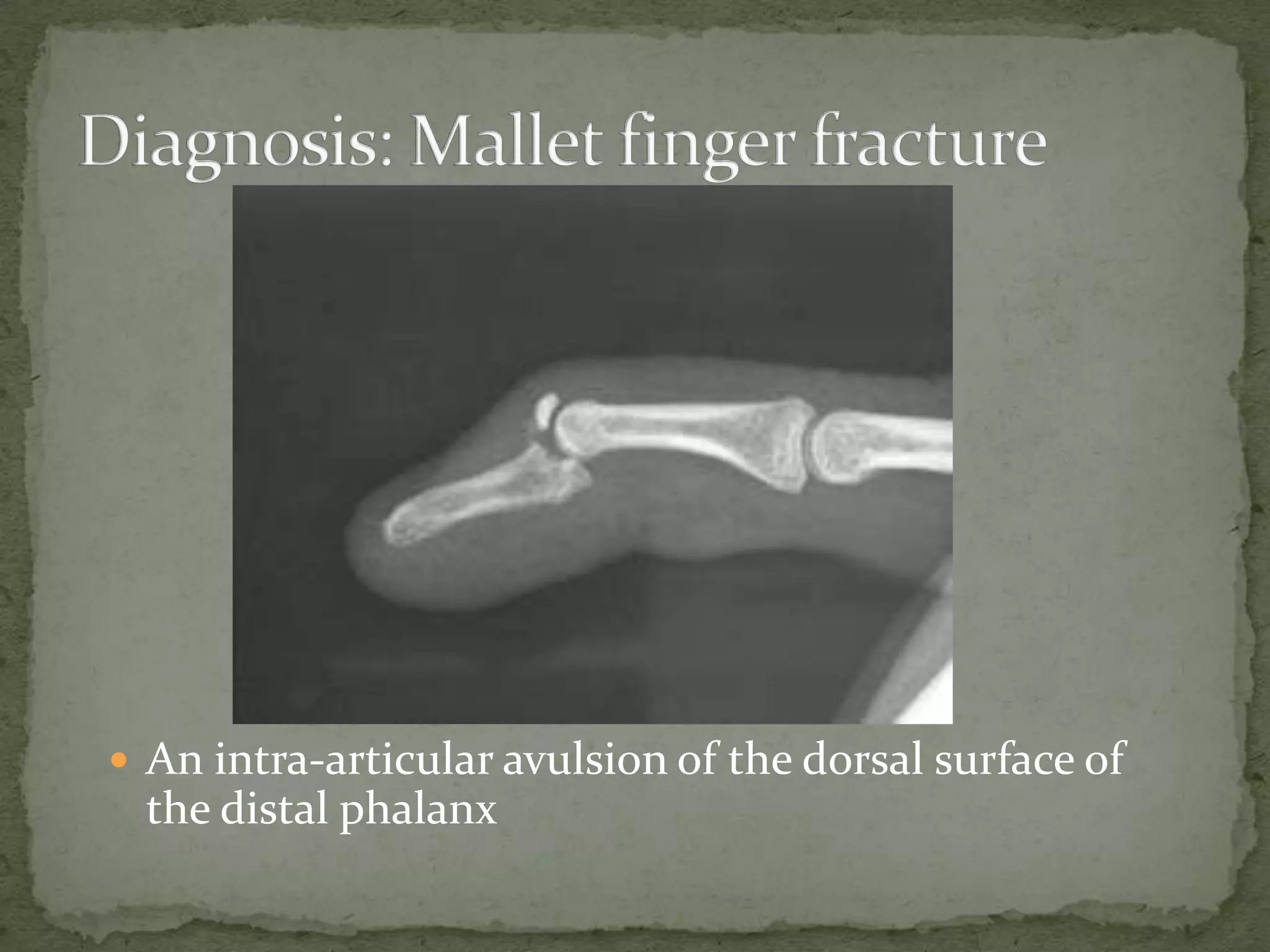 Mallet Finger Power Point | PPTX