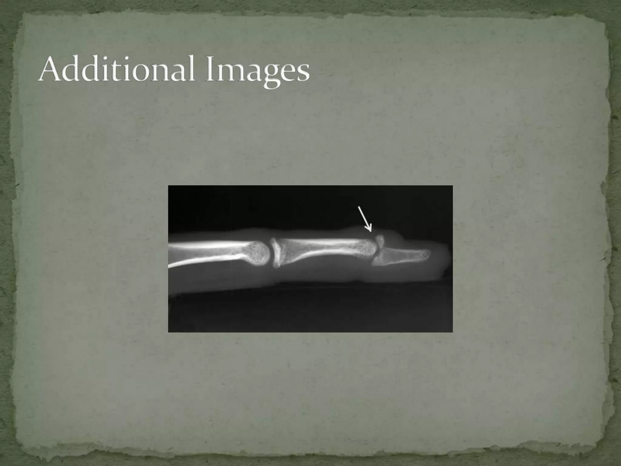 Mallet Finger Power Point | PPTX