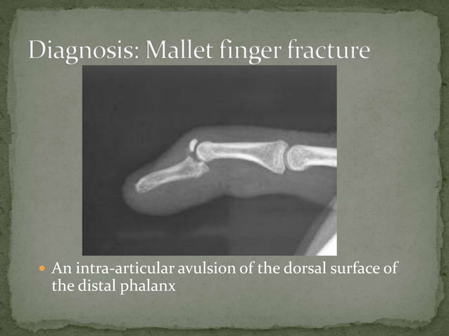 Mallet Finger Power Point | PPTX | Death, Injury, or Military Conflict ...