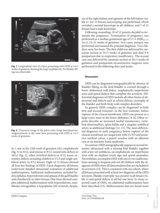 OEIS - omphalocele - exstrophy - imperforate - spinal defects | PDF