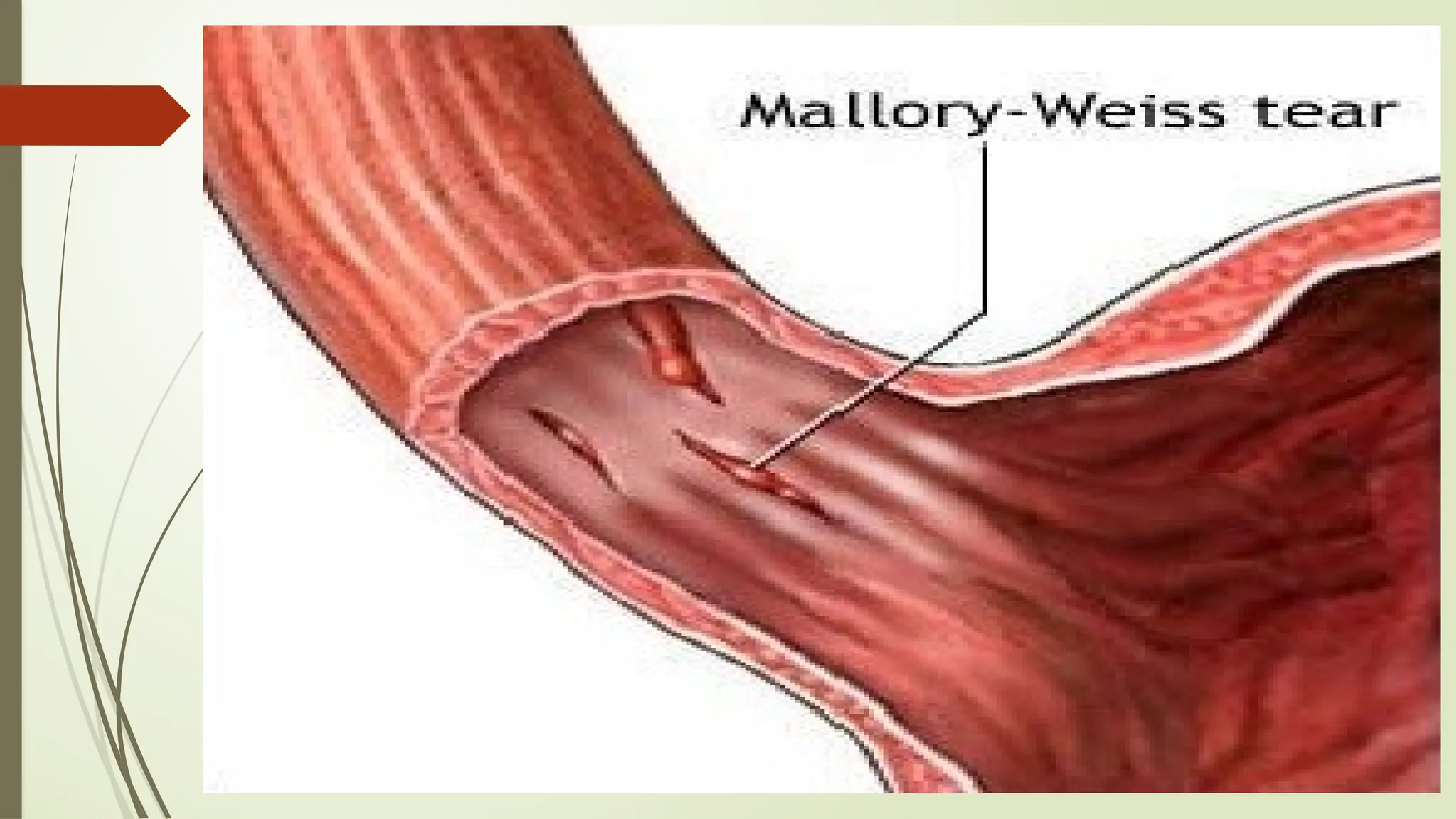 MALLORY-WEISS SYNDROME.pptxxxxxxxxxxxxxx | PPTX