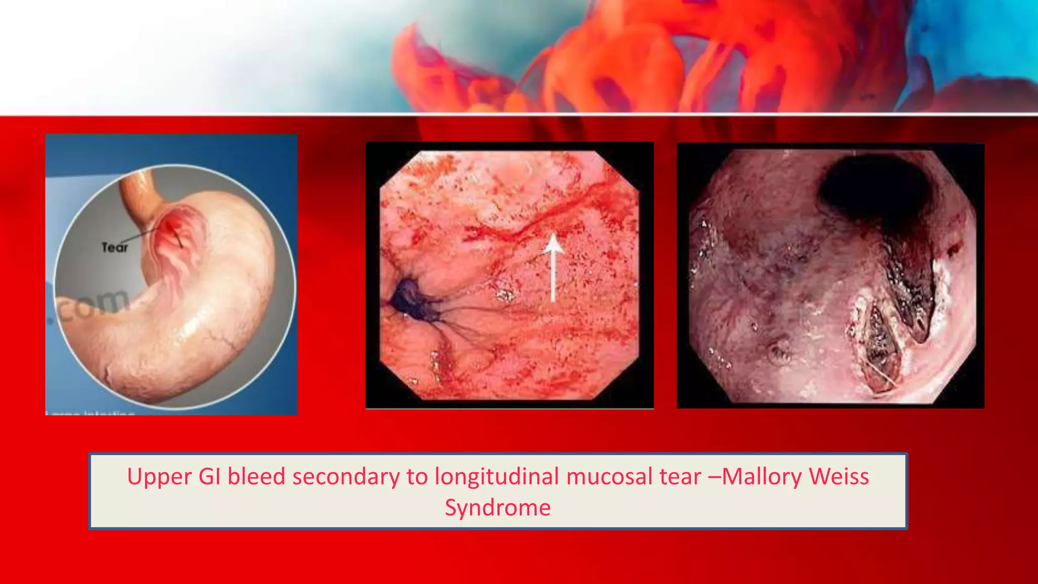 Mallory weiss syndrome | PPTX