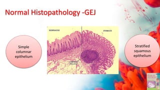 Mallory weiss syndrome | PPTX