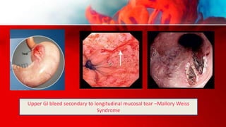 Mallory weiss syndrome | PPTX
