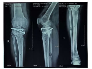 malnited tibial platue....pptxbbbbbbbbge | PPTX | Physical Therapy ...