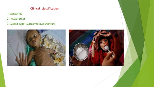 Malnutrition Presentation Fot Medical Pptx