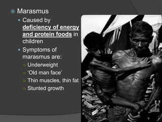 Malnutrition | PPT