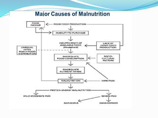 Malnutrition | PPT