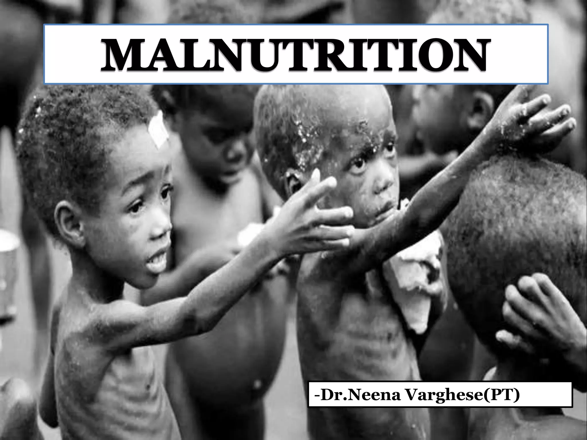 Malnutrition | PPTX