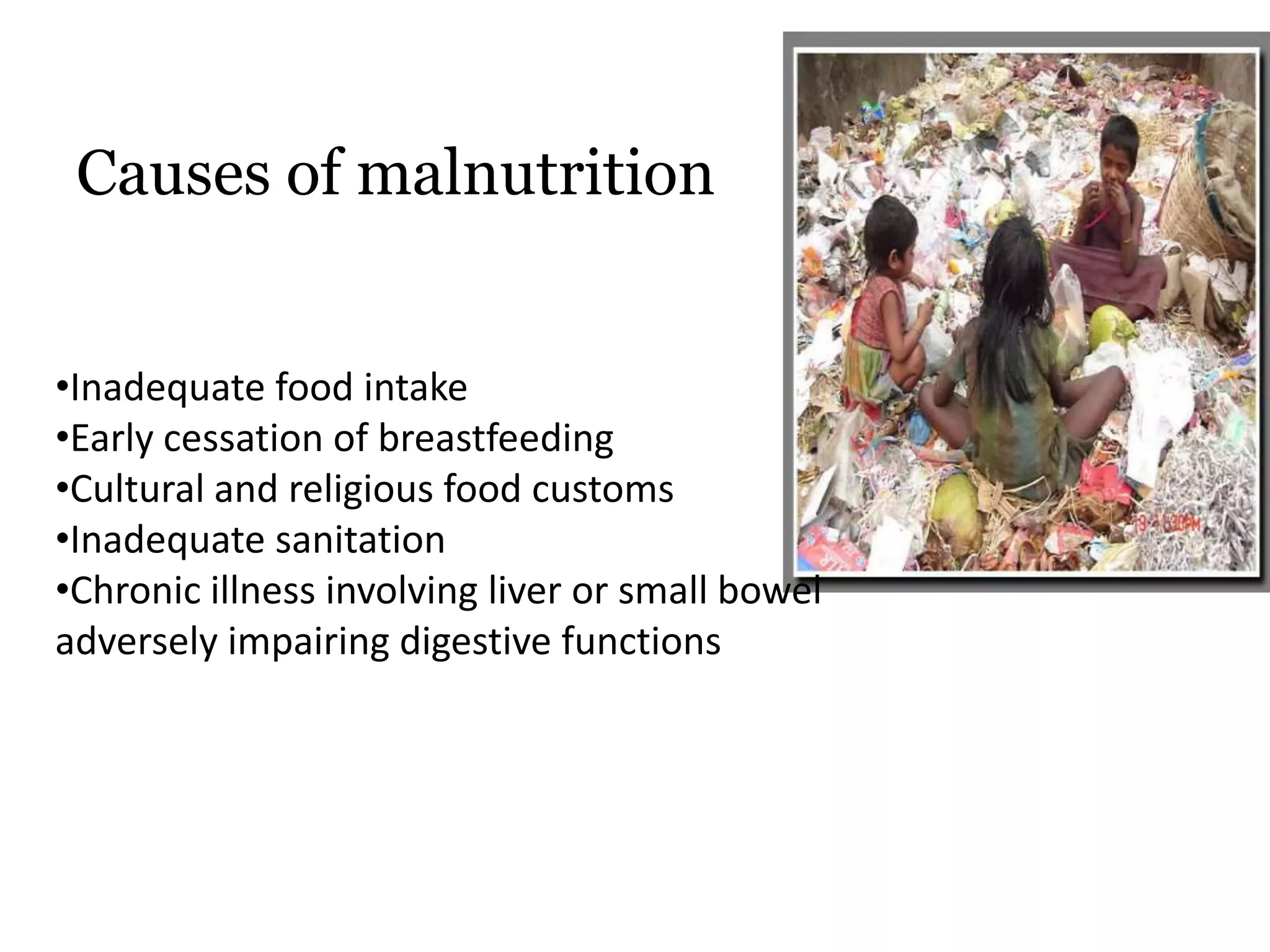 Malnutrition | PPTX