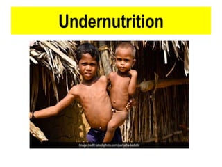 Malnutrition | PPTX