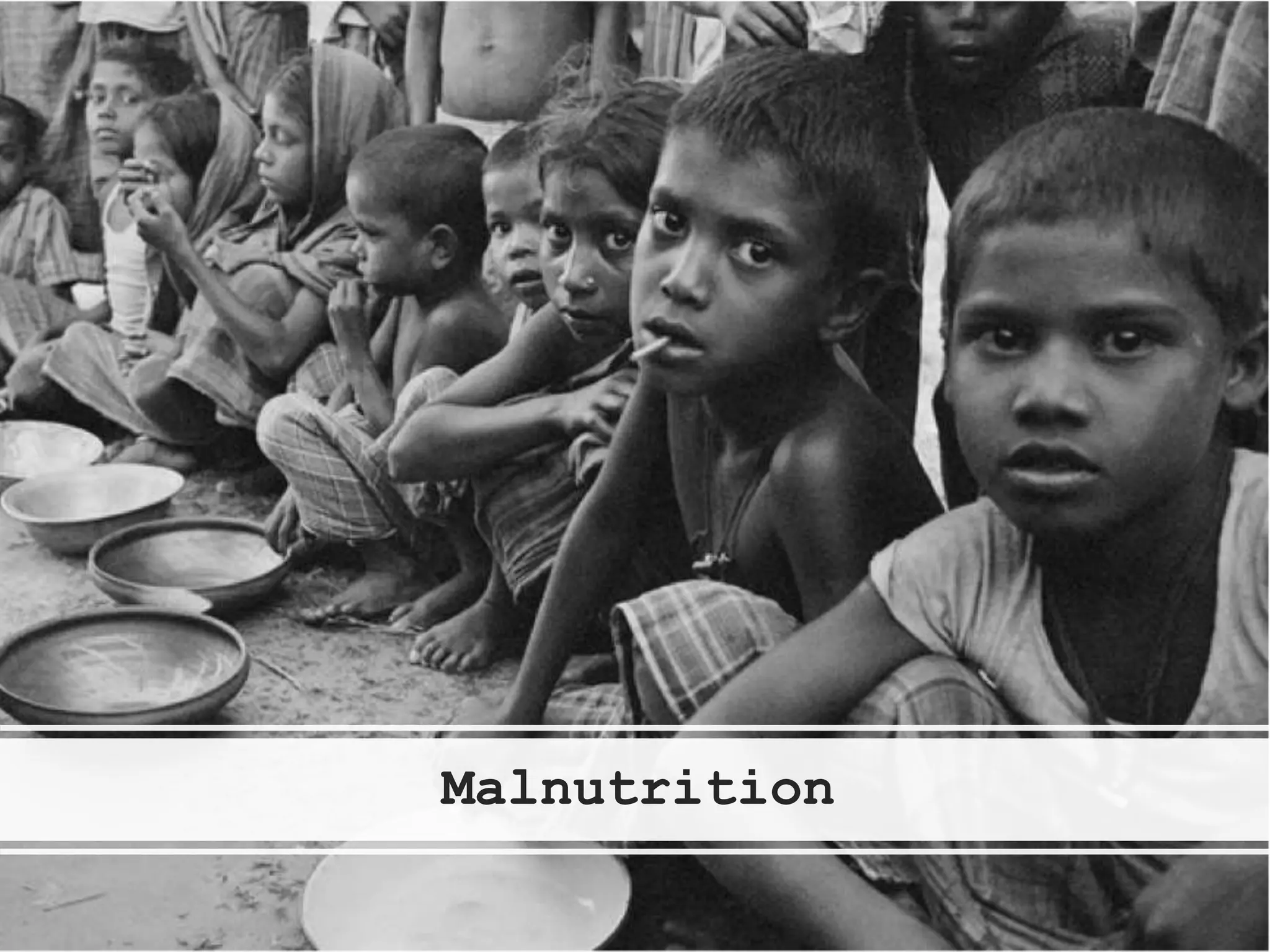 Malnutrition (A global problem) | PPTX
