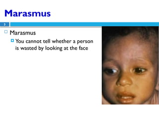 Malnutrition pharmacotherapy.ppt.PG.pptx