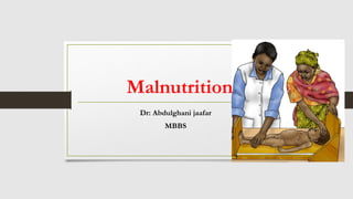 malnutrition (MAM and SAM ) in pediatrics.pptx