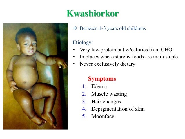 Malnutrition consequences, causes, prevention and control