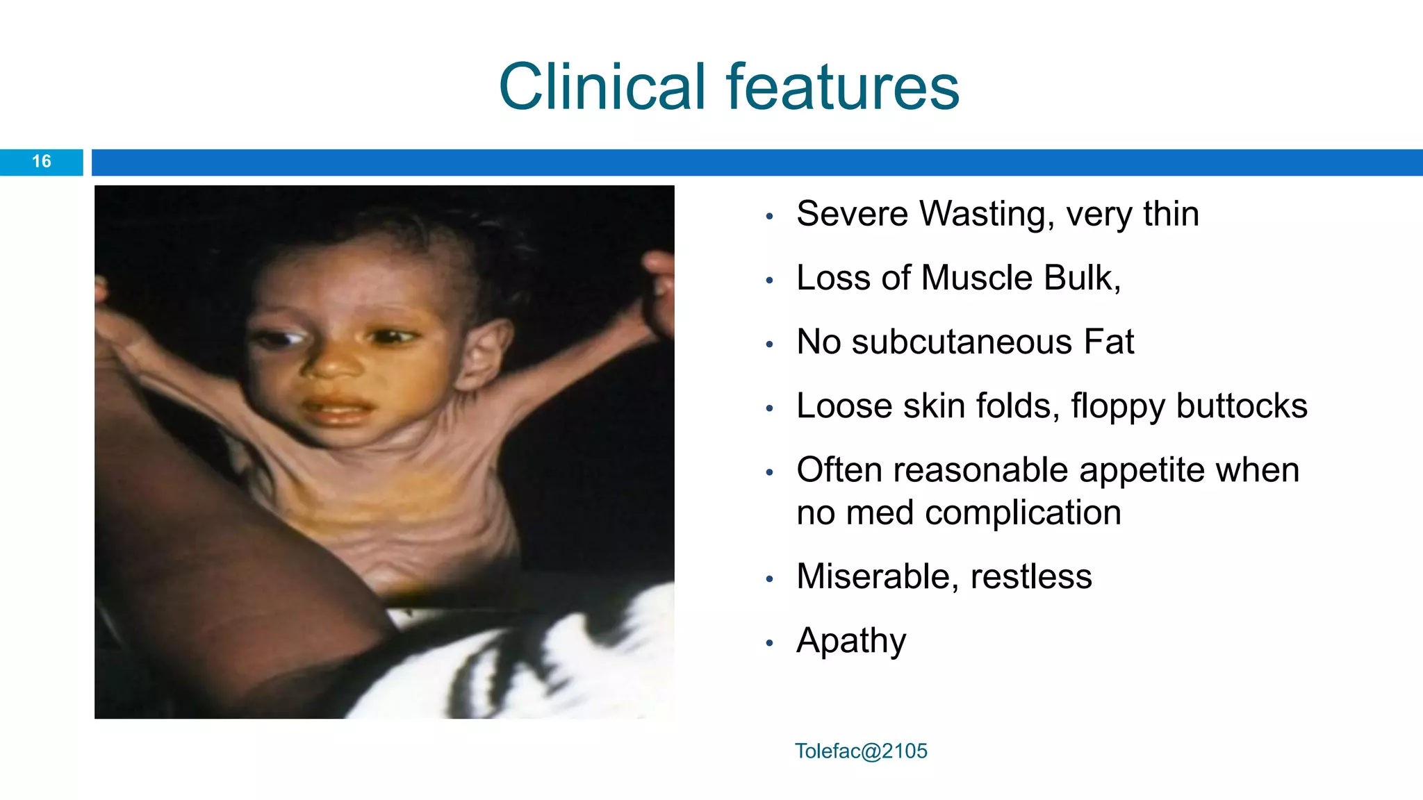 Malnutrition & Undernutrition | PPTX