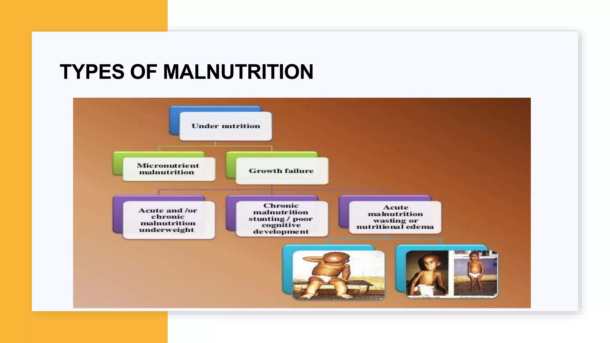 Malnutrition | PPTX