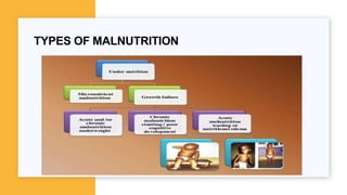 Malnutrition | PPTX