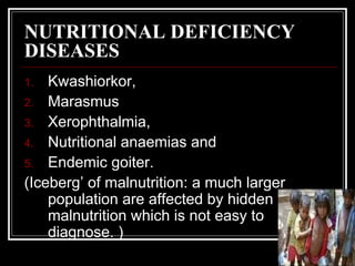 Malnutrition Among Indian Children | PPT