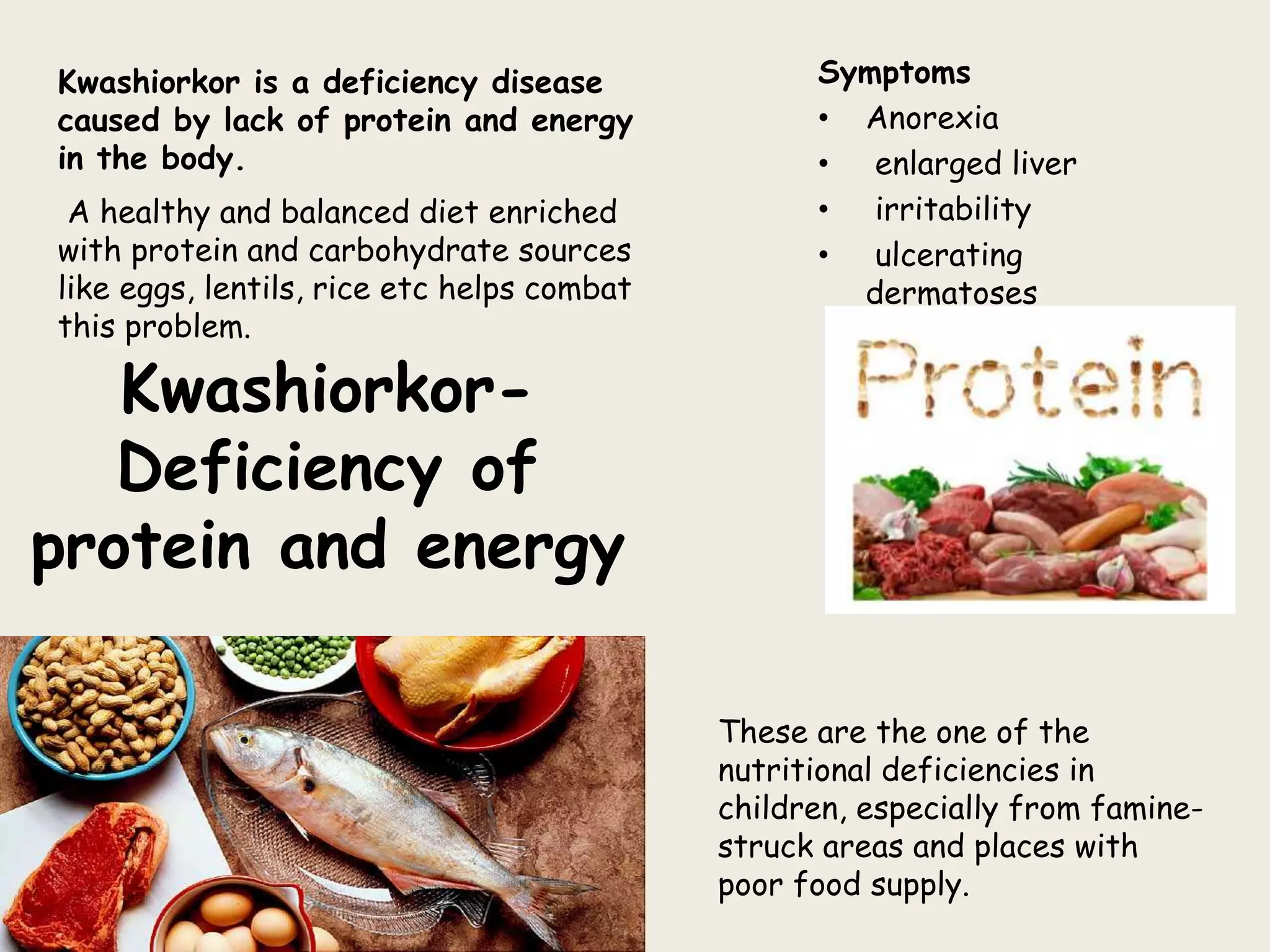 Malnutrition and deficiency diseases | PPTX
