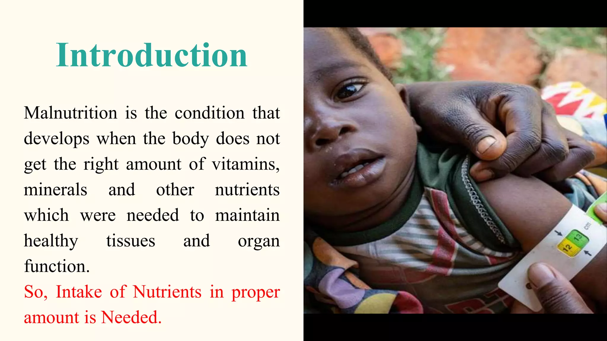 Malnutrition and its prevention.pptx