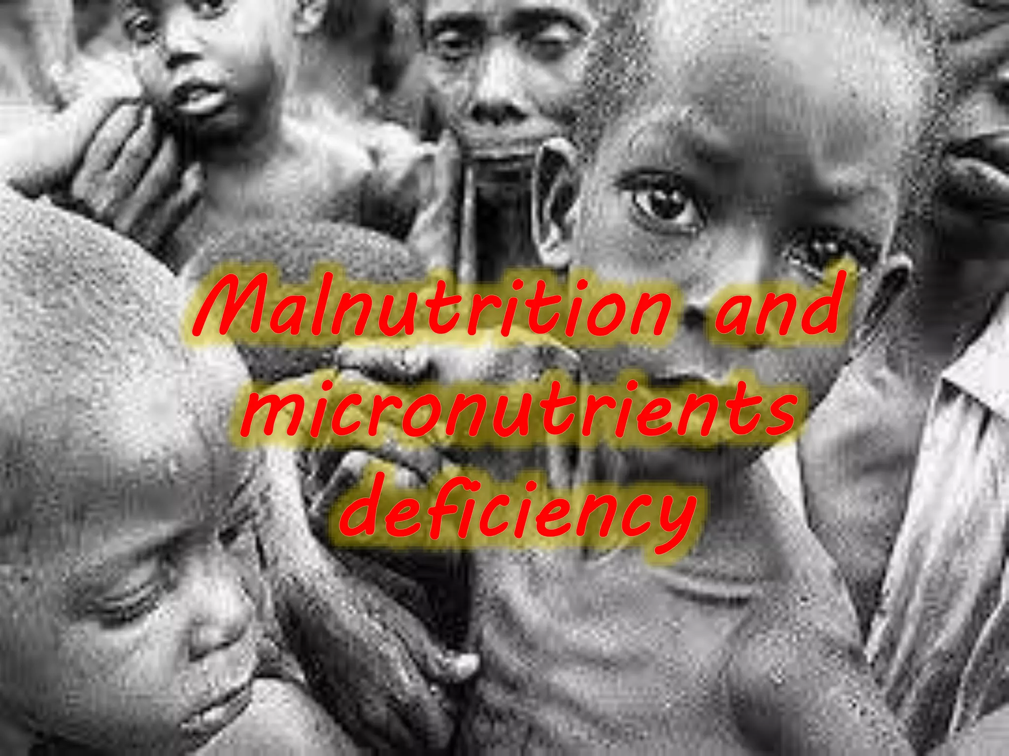 Malnutrition and Micronutrients Deficiency | PPTX