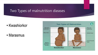 Malnutrition by Annu.pptx