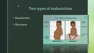 Malnutrition by Deepa.pptx