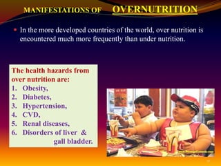 Malnutrition by dr najeeb | PPTX