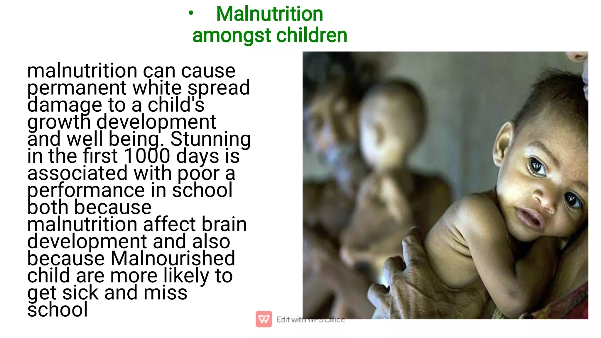 Malnutrition by Mahi.pdf