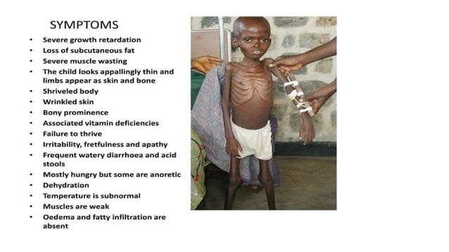 Malnutrition,PEM( kwashiorkor,marasmus).pptx