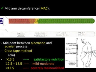 Malnutrition under 5yr | PPTX
