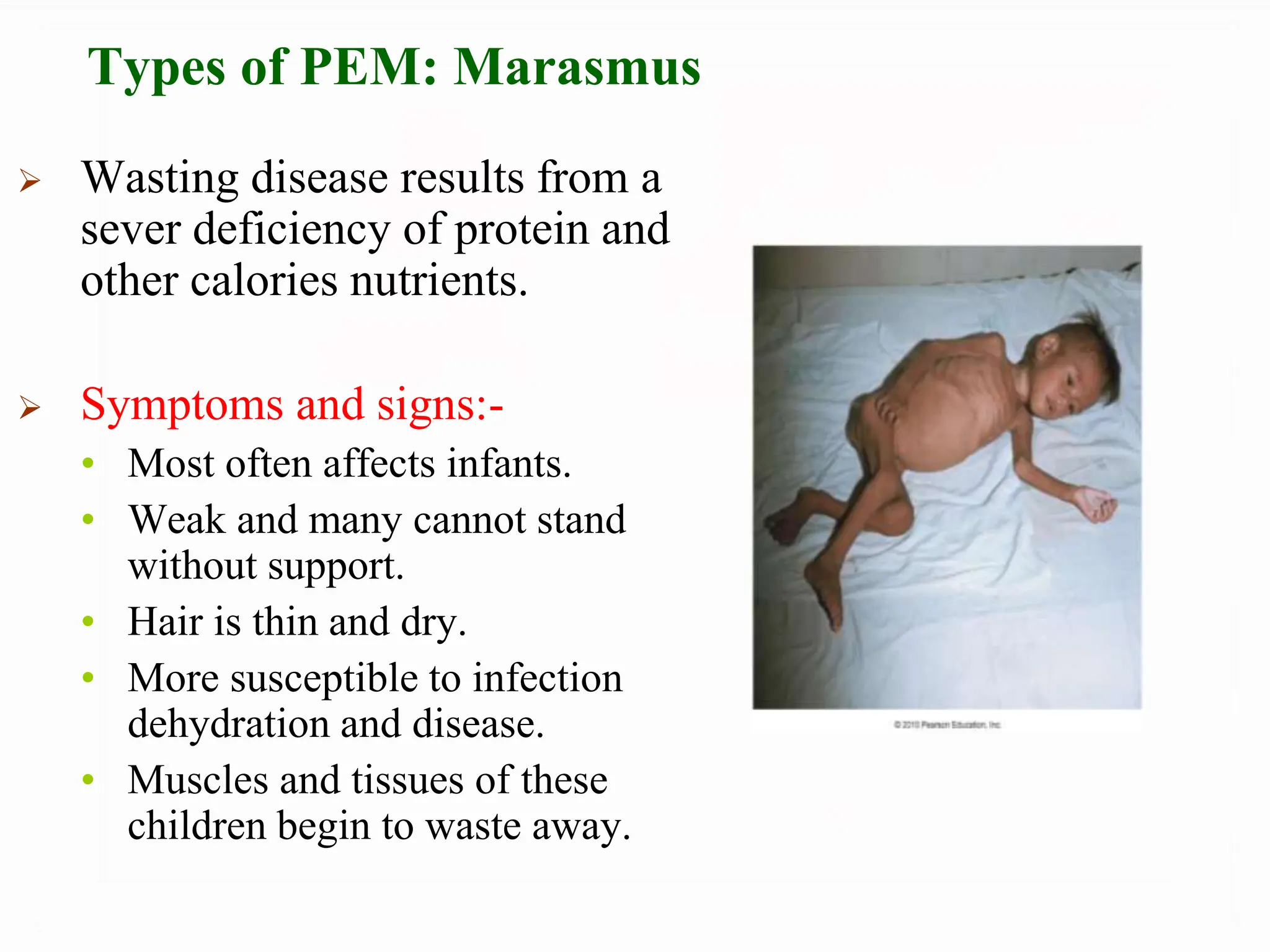 Malnutrition in health and disease of child | PPTX