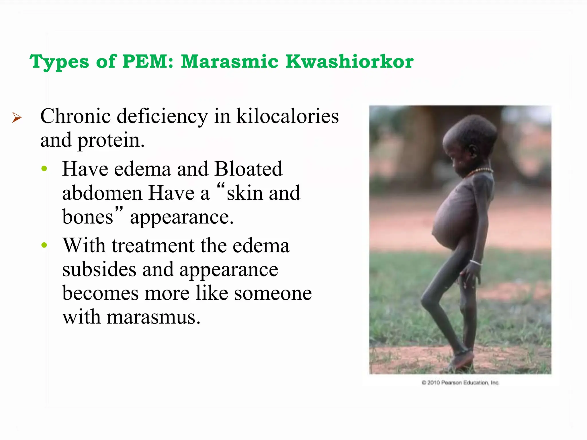 Malnutrition in health and disease of child | PPTX